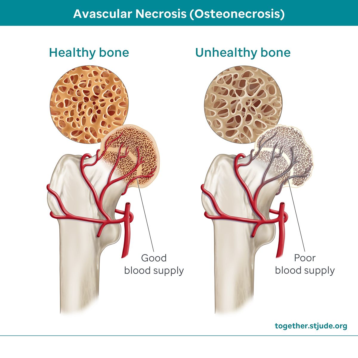 Avascular Necrosis Avn Also Called Osteonecrosis