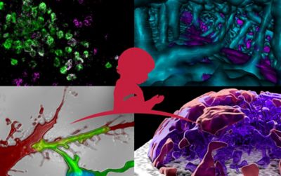 Advances in Sickle Cell Disease | St. Jude Research