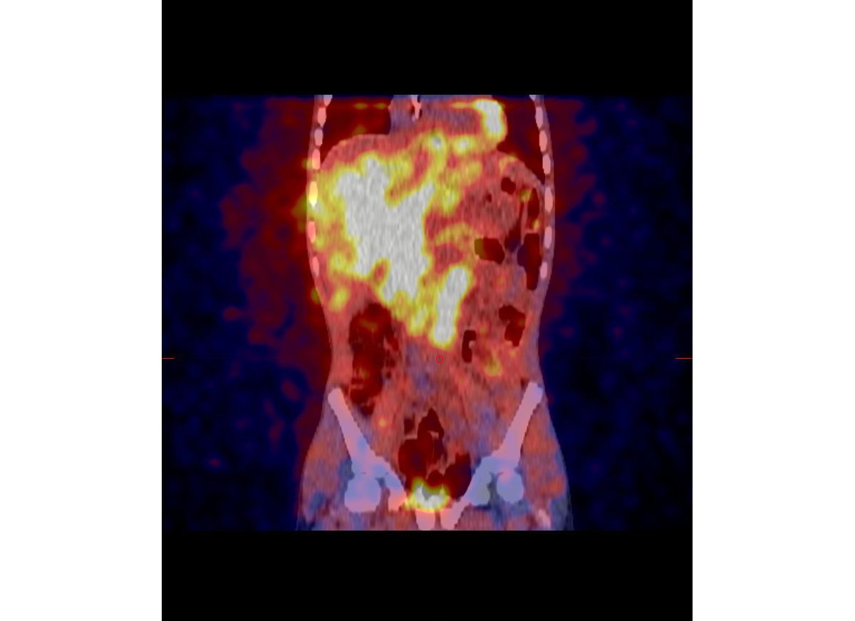 MIBG Scan - Together by St. Jude™