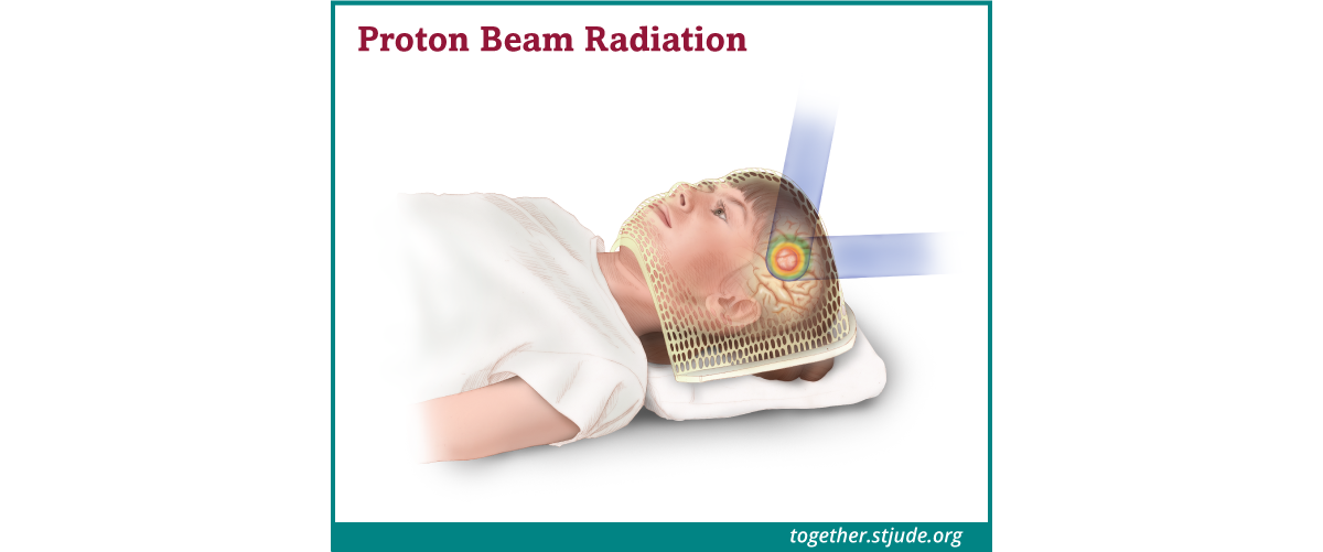 Proton Beam Radiation for Pediatric Cancer Patients - Together by St. Jude™