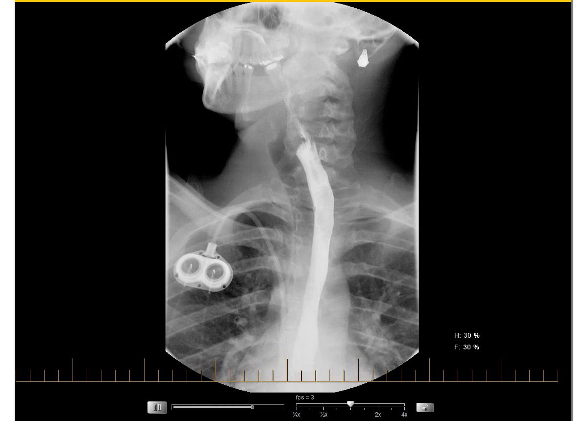 Upper GI series test - Together by St. Jude™